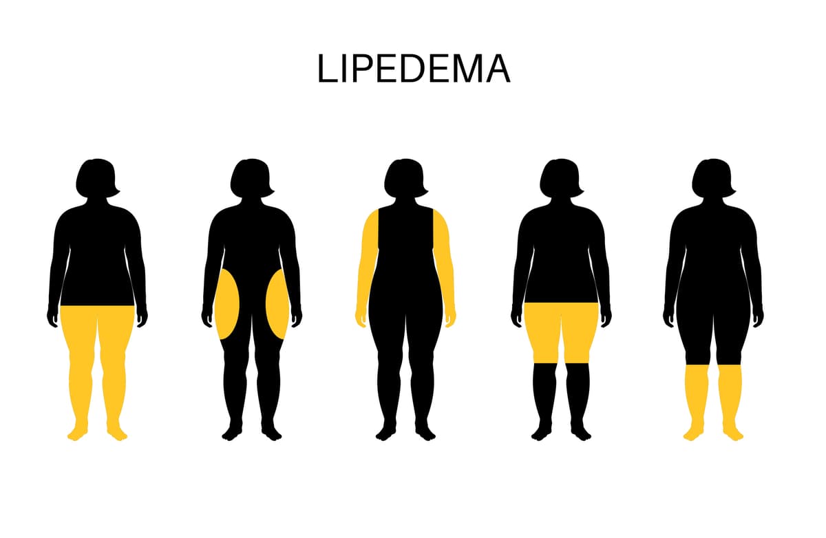 Principais Exames para o Diagnóstico de Lipedema